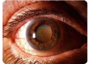 Saiba tudo sobre a Catarata - Oftalmo Centro